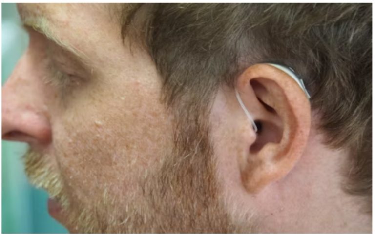 Understanding Hearing Aid Implant: A Comprehensive Guide to Improved ...